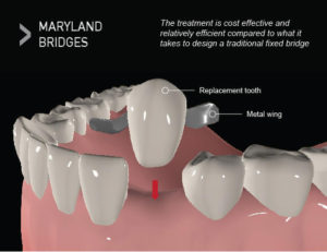 Types of Dental Bridges: What Type is Best for Me?