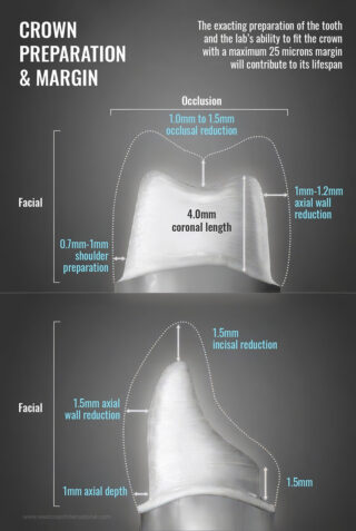 Crown Preparation: Should The Dentist Remove Your Old Fillings?