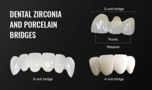 10 Problems with Bridges for Teeth and How to Fix Them