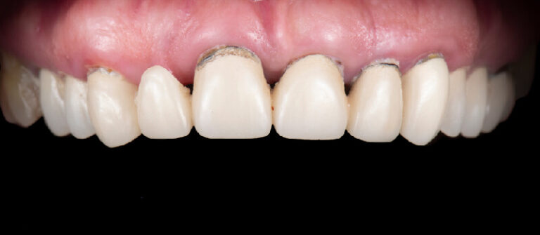 10 Problems with Bridges for Teeth and How to Fix Them